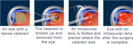 Cataract Surgery - Modern & Advanced Techniques | Boston Eye Group