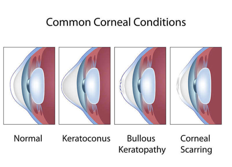 Cornea Center Boston | Corneal Transplants Boston | Boston Eye Group