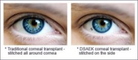 Corneal Transplant Boston | DSEK Procedure Brookline | Boston Eye MA
