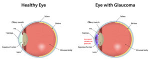 Glaucoma Boston | Glaucoma Treatment Brookline | Boston Eye Group