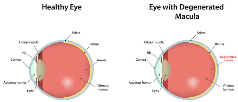 Macular Degeneration - Causes & Treatment | Boston Eye Group in Boston